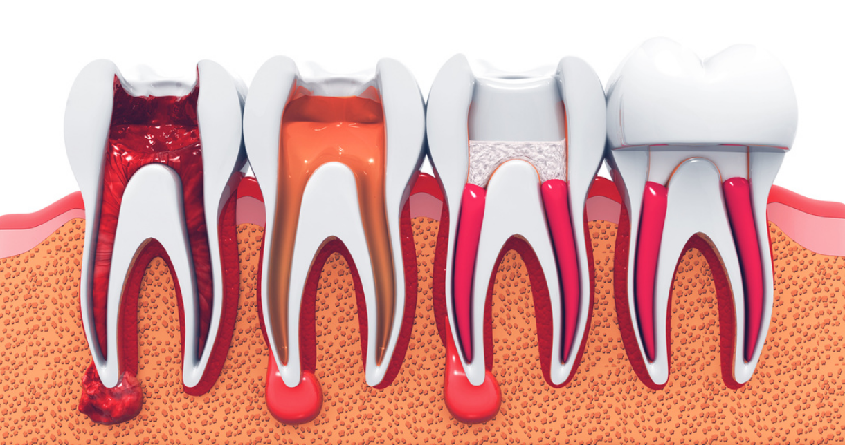 Advanced RCT - Jaaz Dentistry